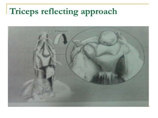 anatomy of elbow & fractures around elbow & surgical options in adults ...