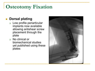 anatomy of elbow & fractures around elbow & surgical options in adults ...