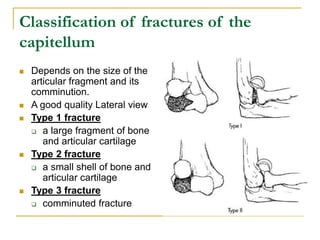 anatomy of elbow & fractures around elbow & surgical options in adults ...