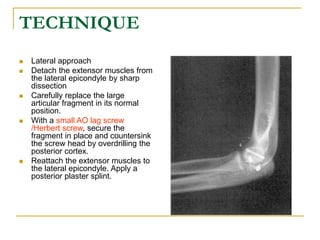 anatomy of elbow & fractures around elbow & surgical options in adults ...