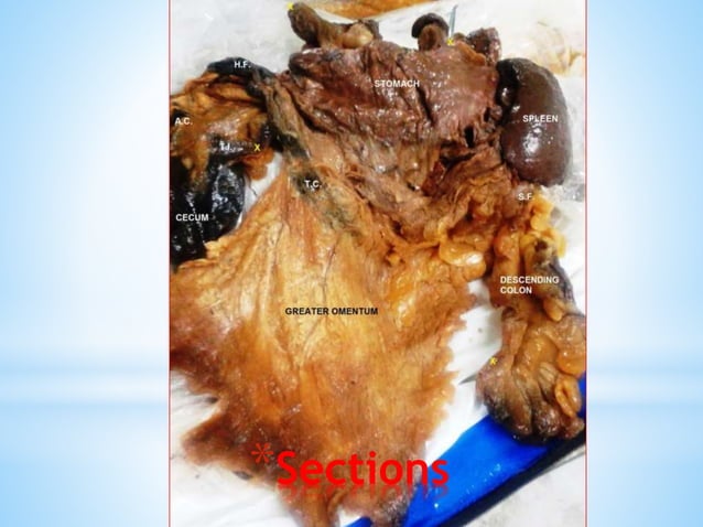 Surgical Anatomy of Cadaveric Abdominal Viscera - Dr Sanjoy Sanyal ...