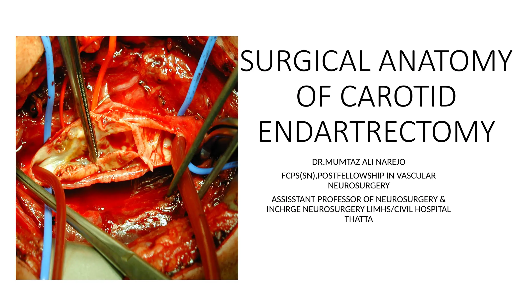 Surgical anatomy of carotid endartrectomy by Dr.Mumtaz Ali.pptx