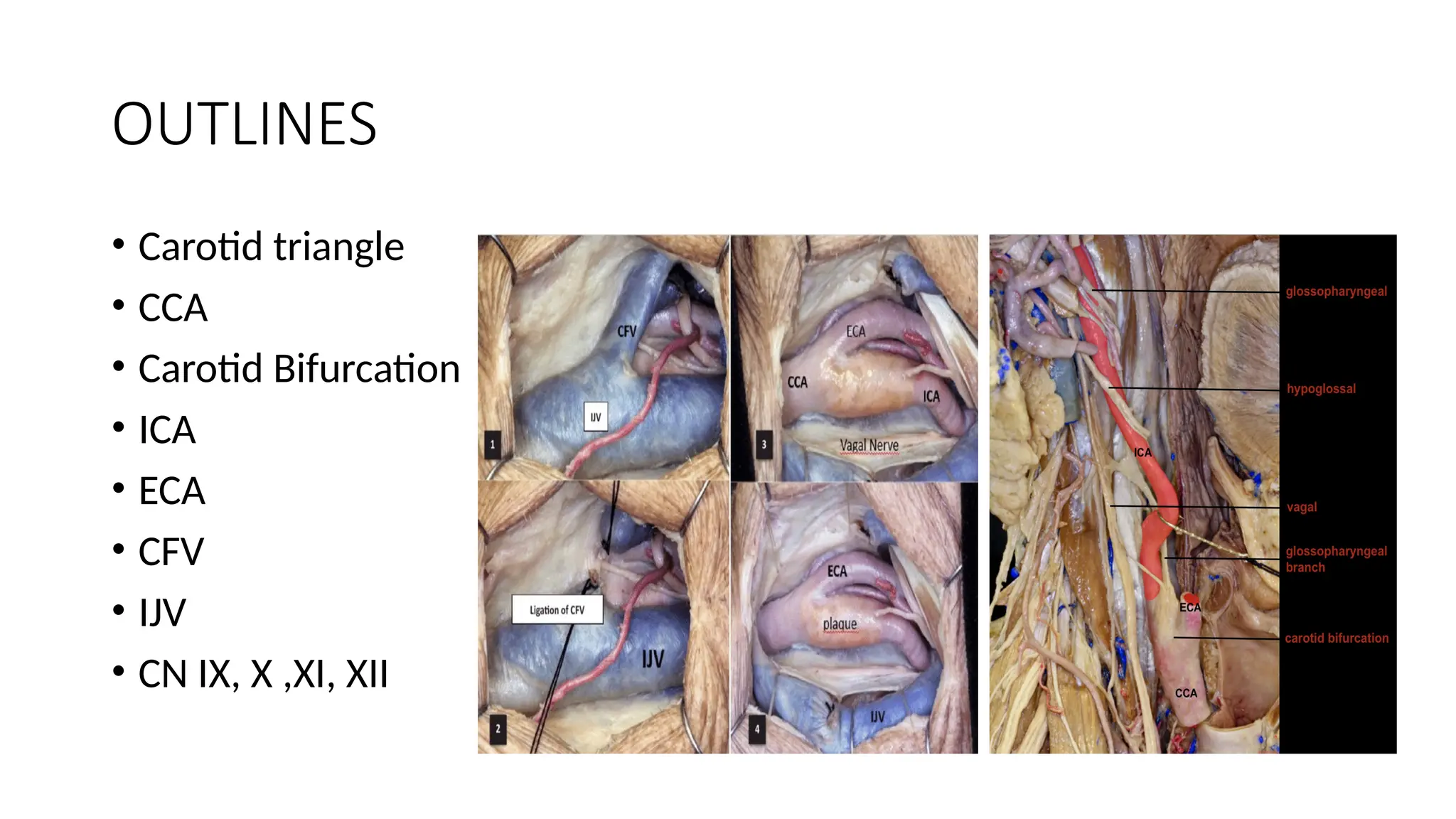 Surgical anatomy of carotid endartrectomy by Dr.Mumtaz Ali.pptx