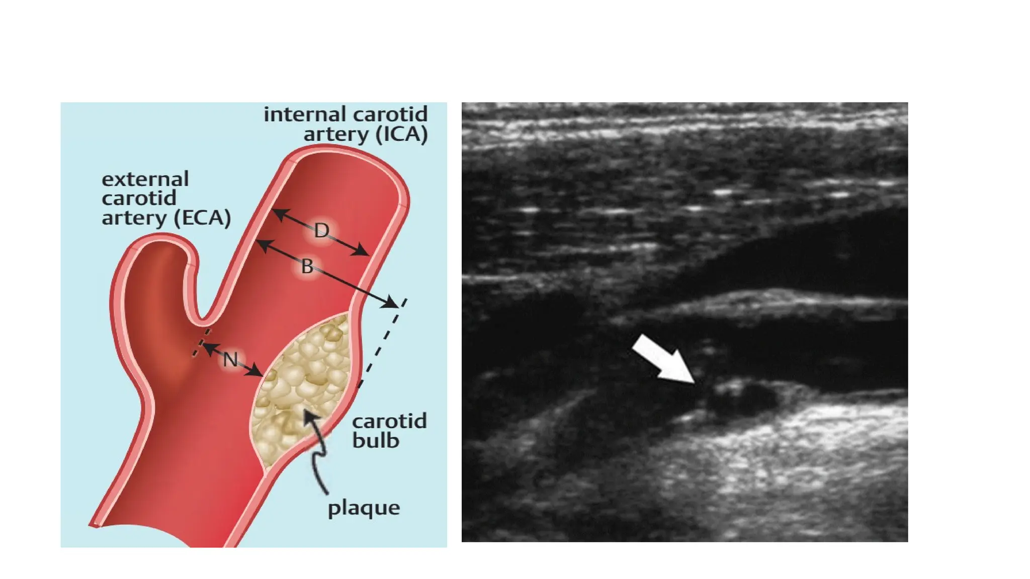 Surgical anatomy of carotid endartrectomy by Dr.Mumtaz Ali.pptx