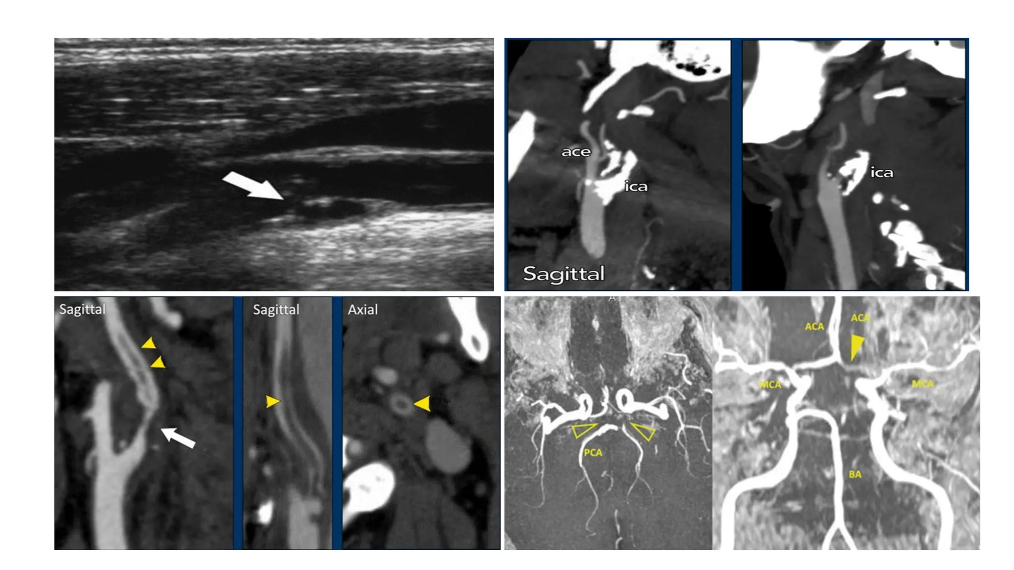 Surgical anatomy of carotid endartrectomy by Dr.Mumtaz Ali.pptx