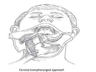 Surgical anatomy of deep neck spaces | PPTX