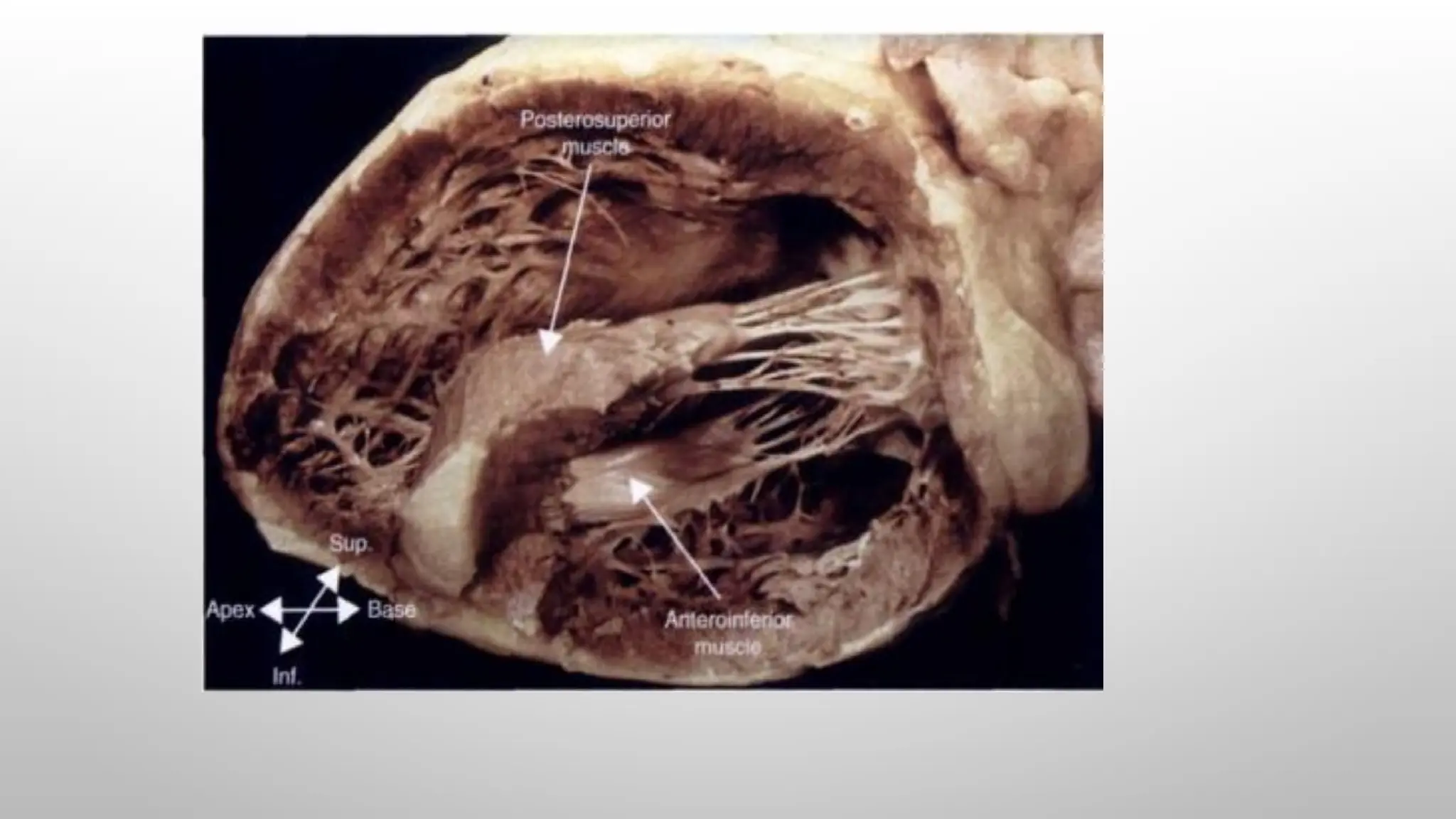 SURGICAL ANATOMY OF HEART-CHAMBER/VALVE/CORONARY/CONDUCTION SYSTEM.pptx