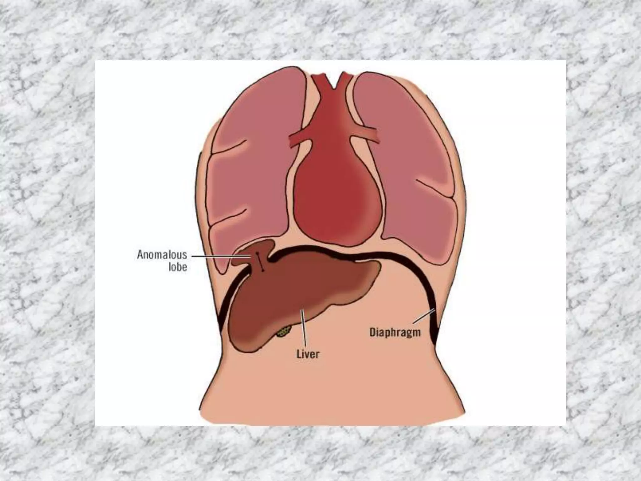 Surgical anatomy of hepatobiliary system by biswajit deka | PPTX