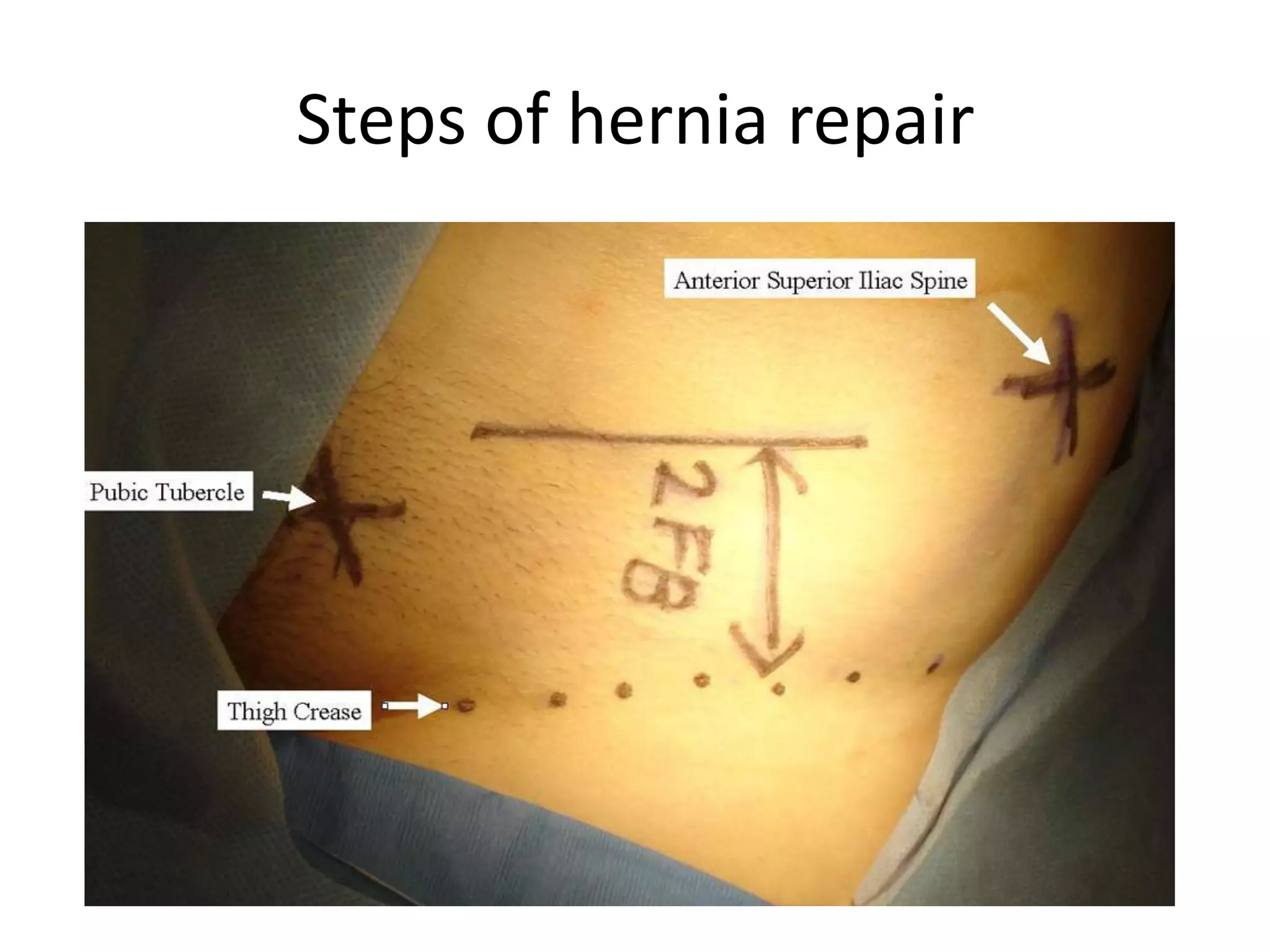 Surgical anatomy of inguinal hernia | PPTX
