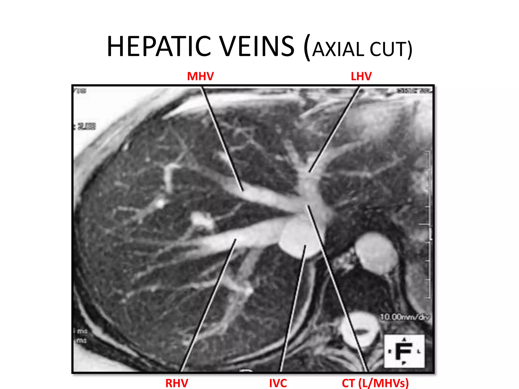 Surgical anatomy of liver | PPTX