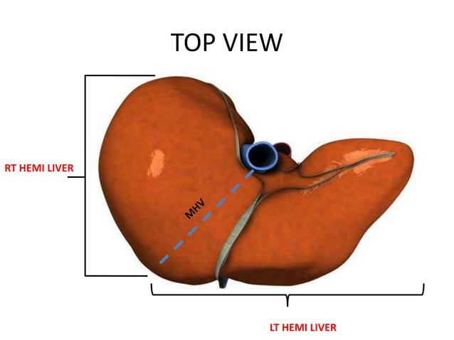Surgical anatomy of liver | PPTX | Blood Disorders | Diseases and ...