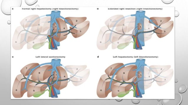 Surgical anatomy of liver | PPTX | Endocrine and Metabolic Diseases ...