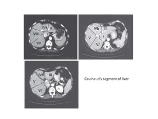 Surgical anatomy of liver.dr quiyum | PPTX