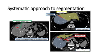 Surgical Anatomy of Liver in detail for undergraduate | PPTX