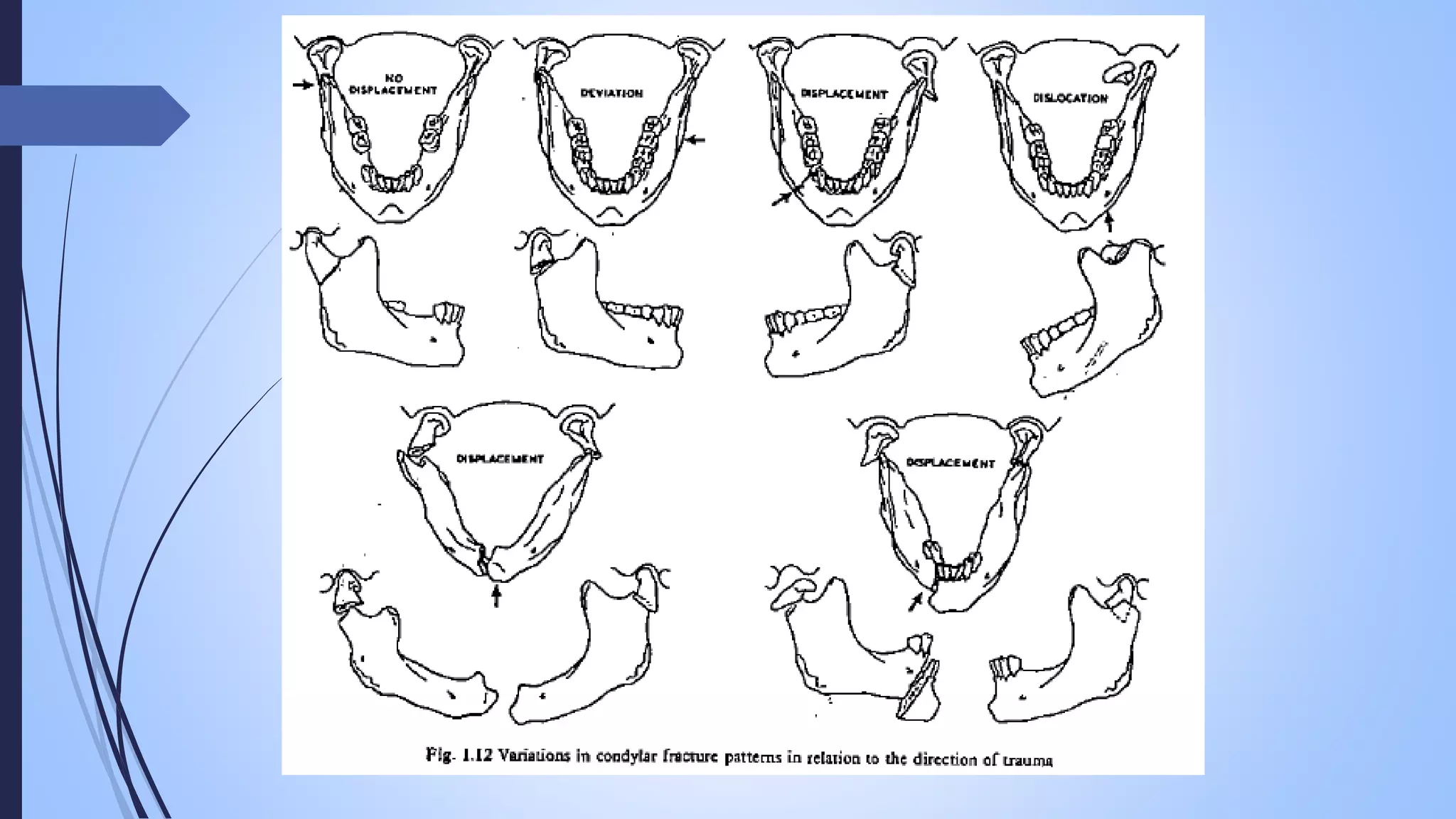 Surgical anatomy of mandible | PPTX