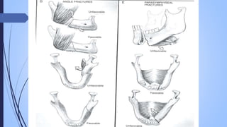 Surgical anatomy of mandible | PPTX