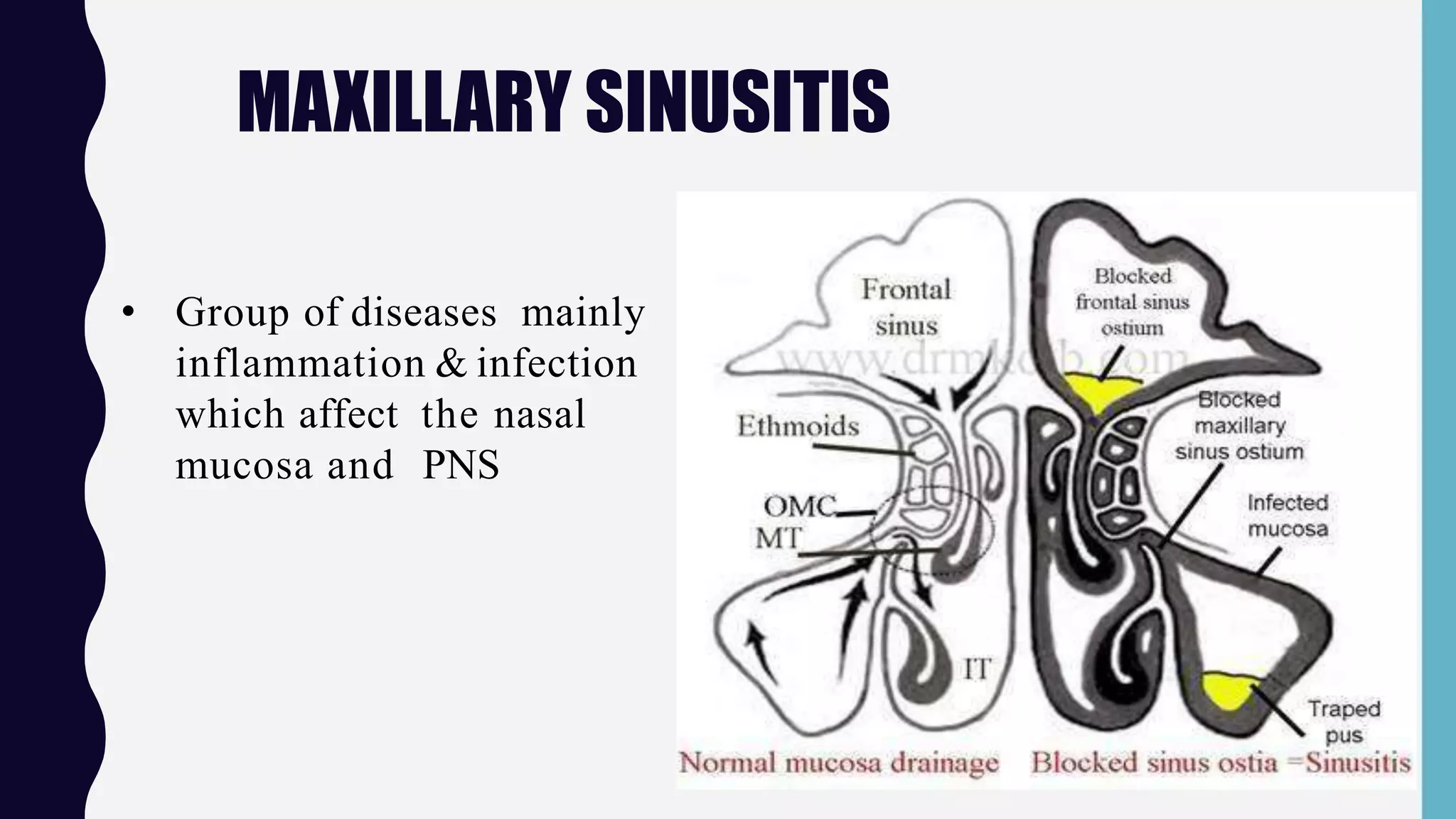 Surgical anatomy of maxillary sinus | PPTX