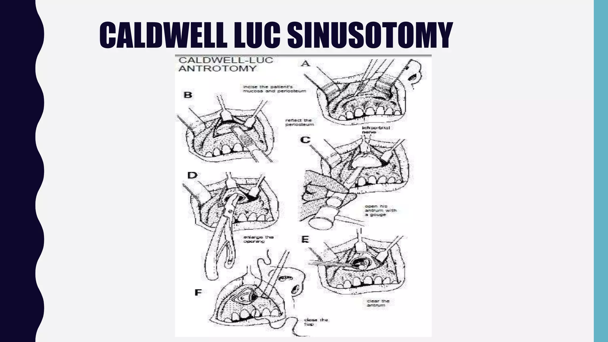Surgical anatomy of maxillary sinus | PPTX