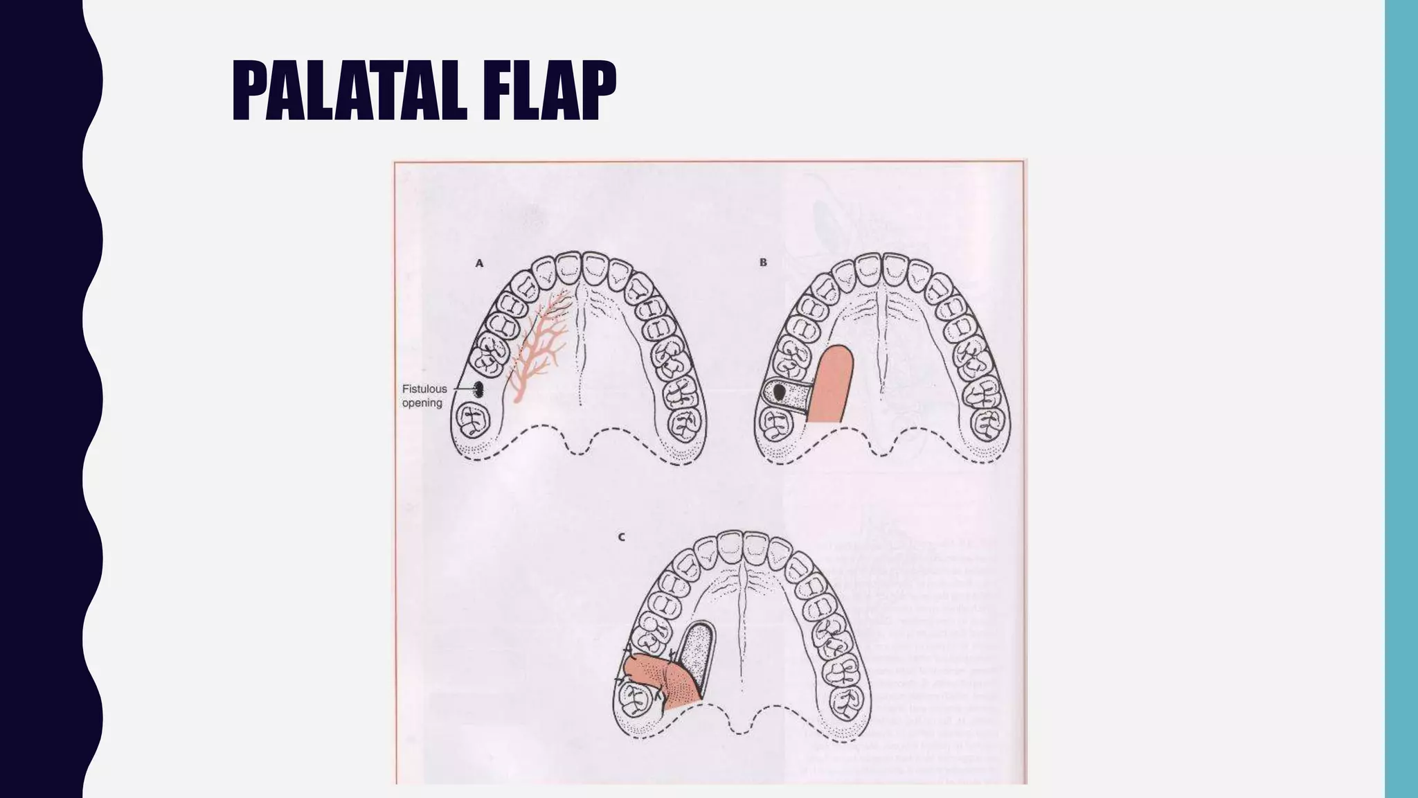 Surgical anatomy of maxillary sinus | PPTX