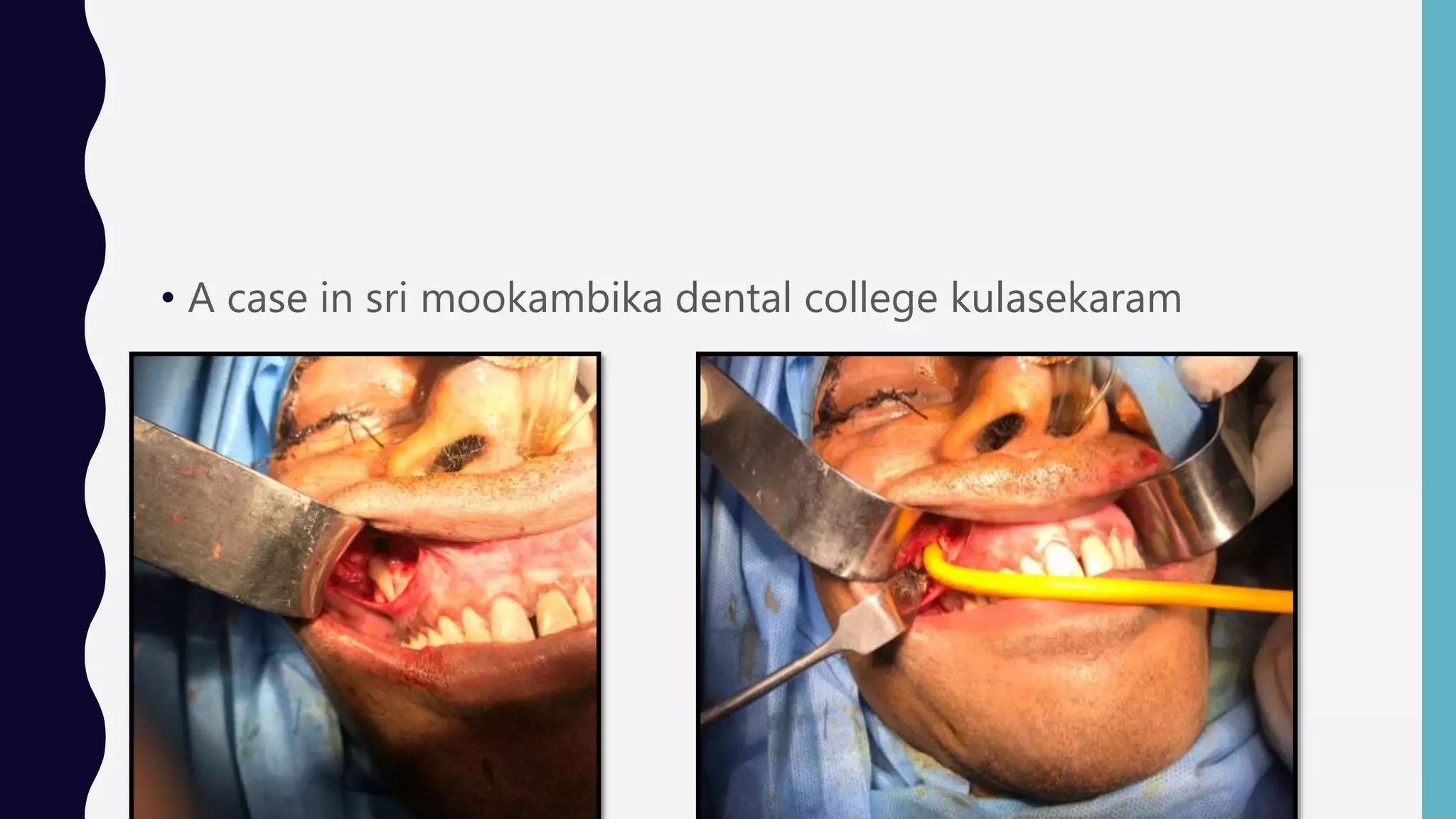 Surgical anatomy of maxillary sinus | PPTX