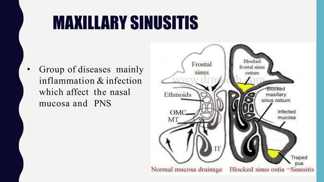 Surgical anatomy of maxillary sinus | PPTX