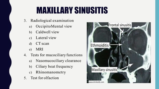 Surgical anatomy of maxillary sinus | PPTX