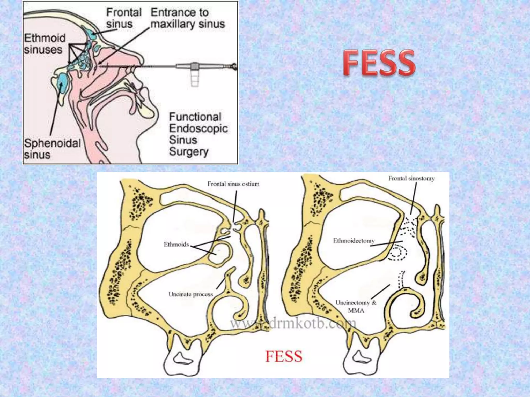 Surgical anatomy of Maxillary Sinus , Lateral wall of nose and Soft ...