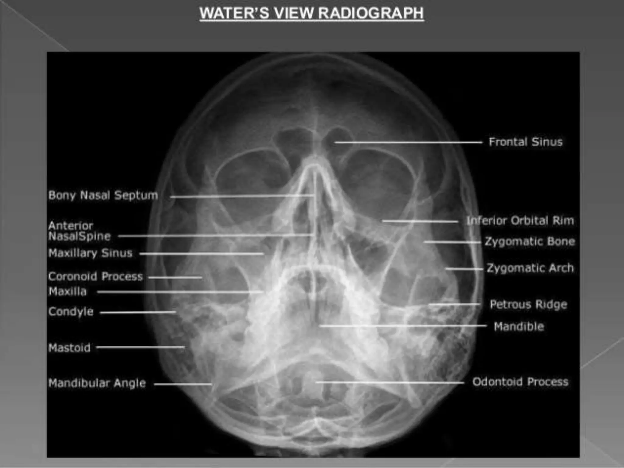 Surgical anatomy of Maxillary Sinus , Lateral wall of nose and Soft ...