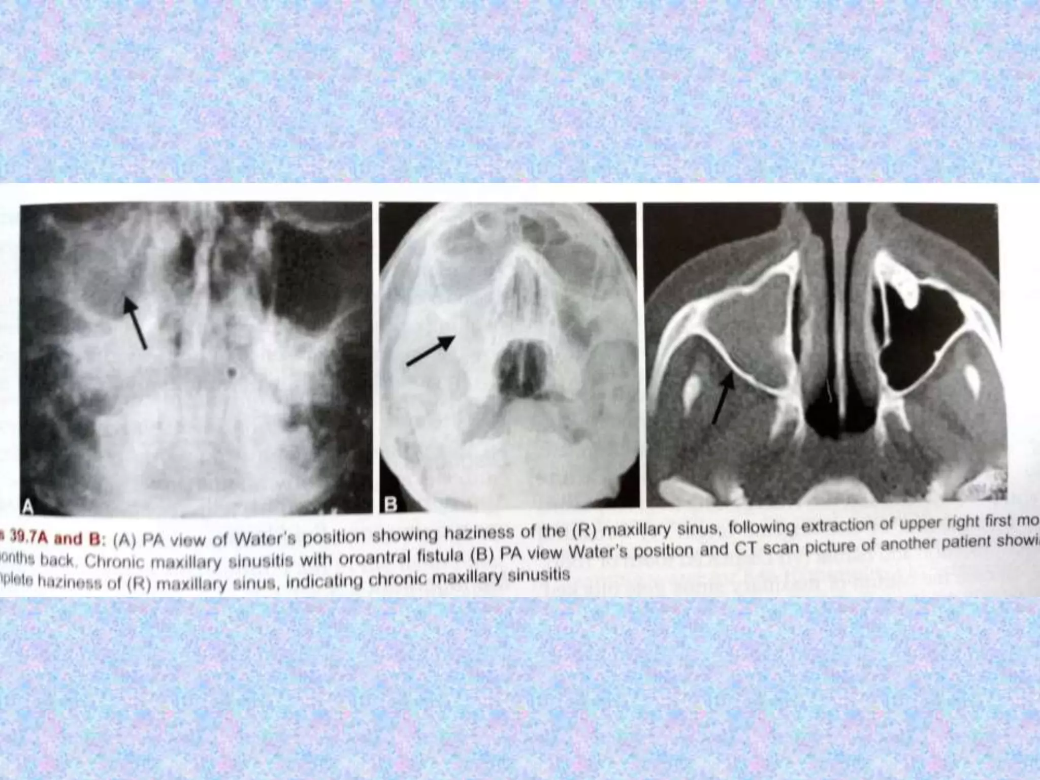 Surgical anatomy of Maxillary Sinus , Lateral wall of nose and Soft ...