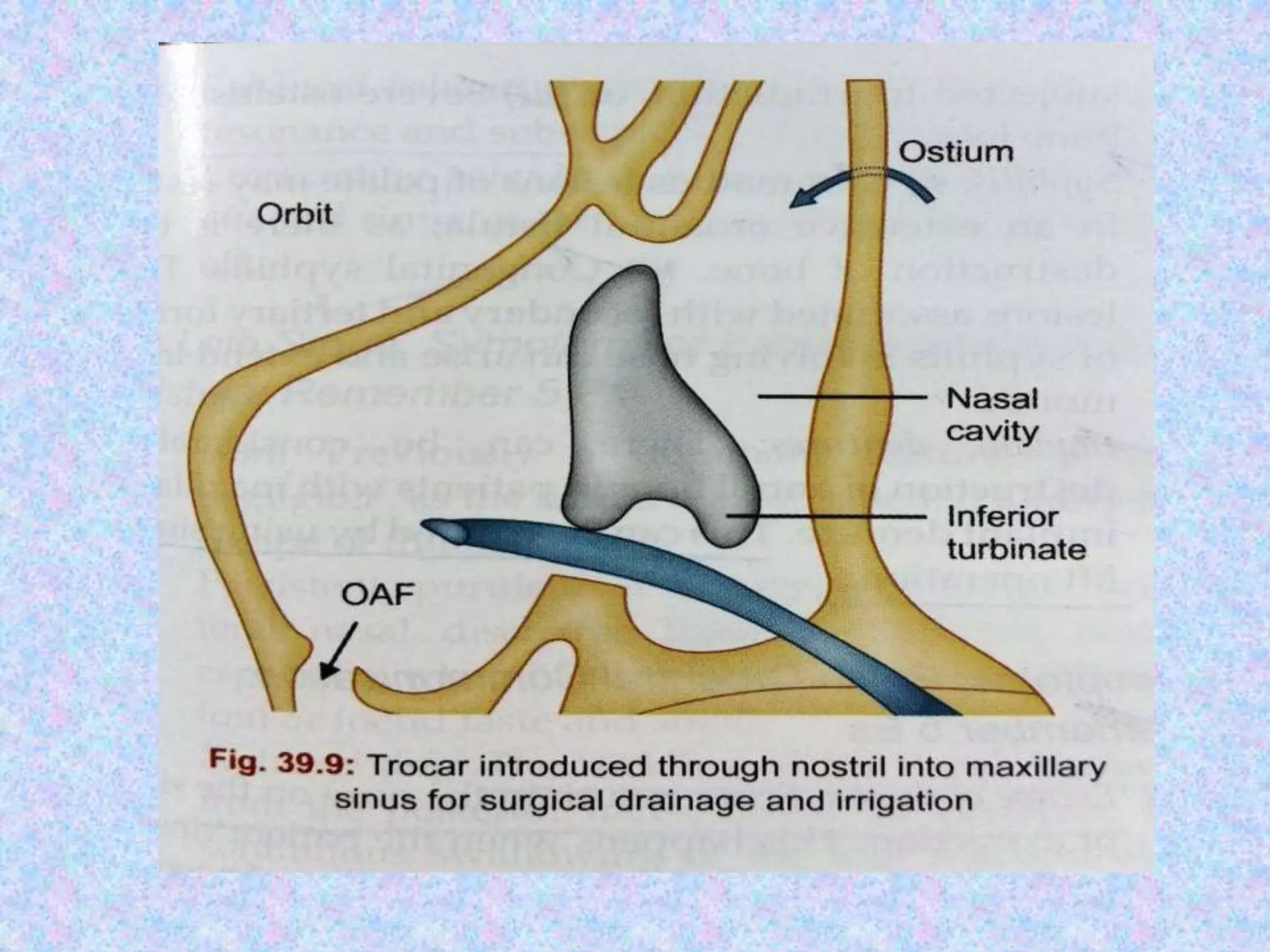 Surgical anatomy of Maxillary Sinus , Lateral wall of nose and Soft ...