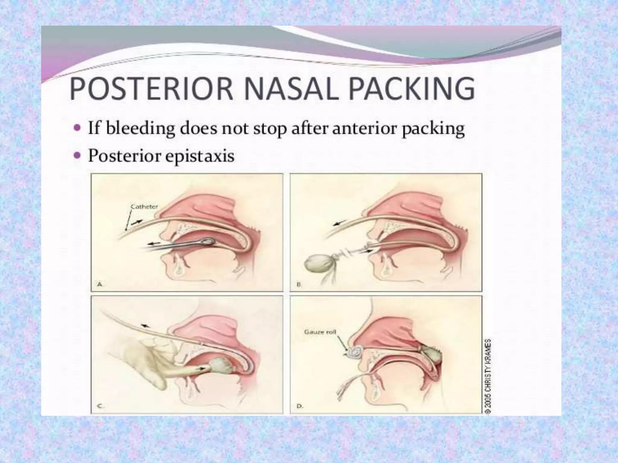 Surgical anatomy of Maxillary Sinus , Lateral wall of nose and Soft ...