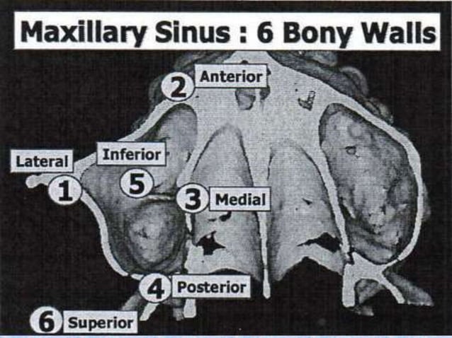 Surgical anatomy of Maxillary Sinus , Lateral wall of nose and Soft ...