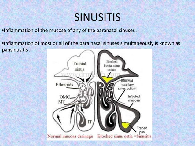 Surgical anatomy of Maxillary Sinus , Lateral wall of nose and Soft ...