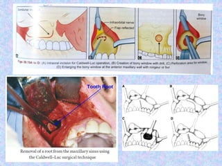 Surgical anatomy of Maxillary Sinus , Lateral wall of nose and Soft ...