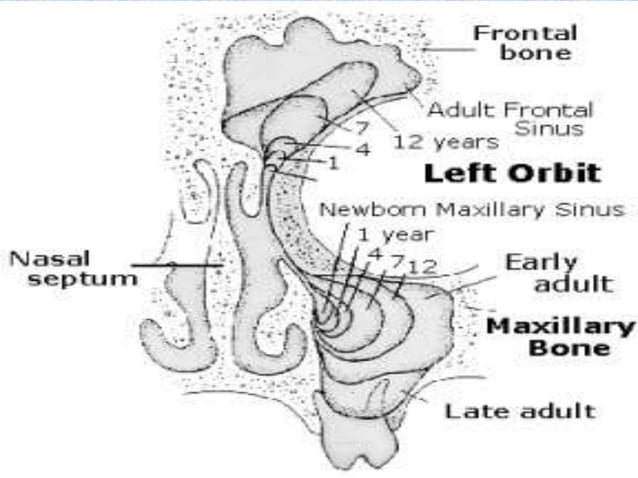 Surgical anatomy of Maxillary Sinus , Lateral wall of nose and Soft ...