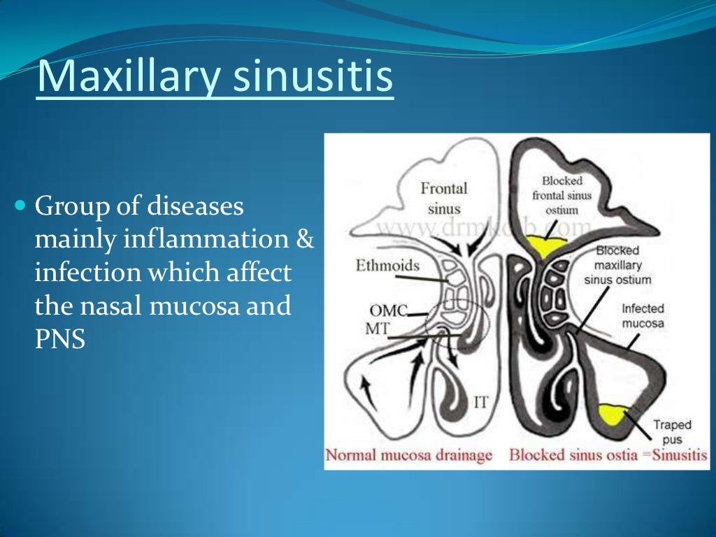 Surgical anatomy of maxillary sinus – note on (2)
