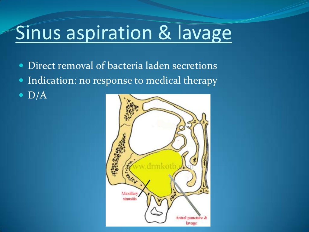 Surgical anatomy of maxillary sinus – note on (2)