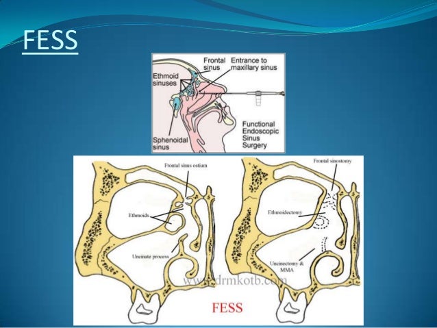 Surgical anatomy of maxillary sinus – note on (2)