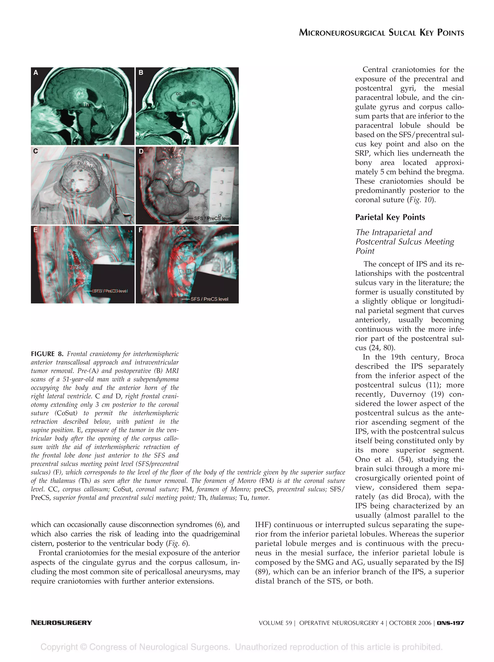Surgical anatomy of microsurgical sulcal key points | PDF