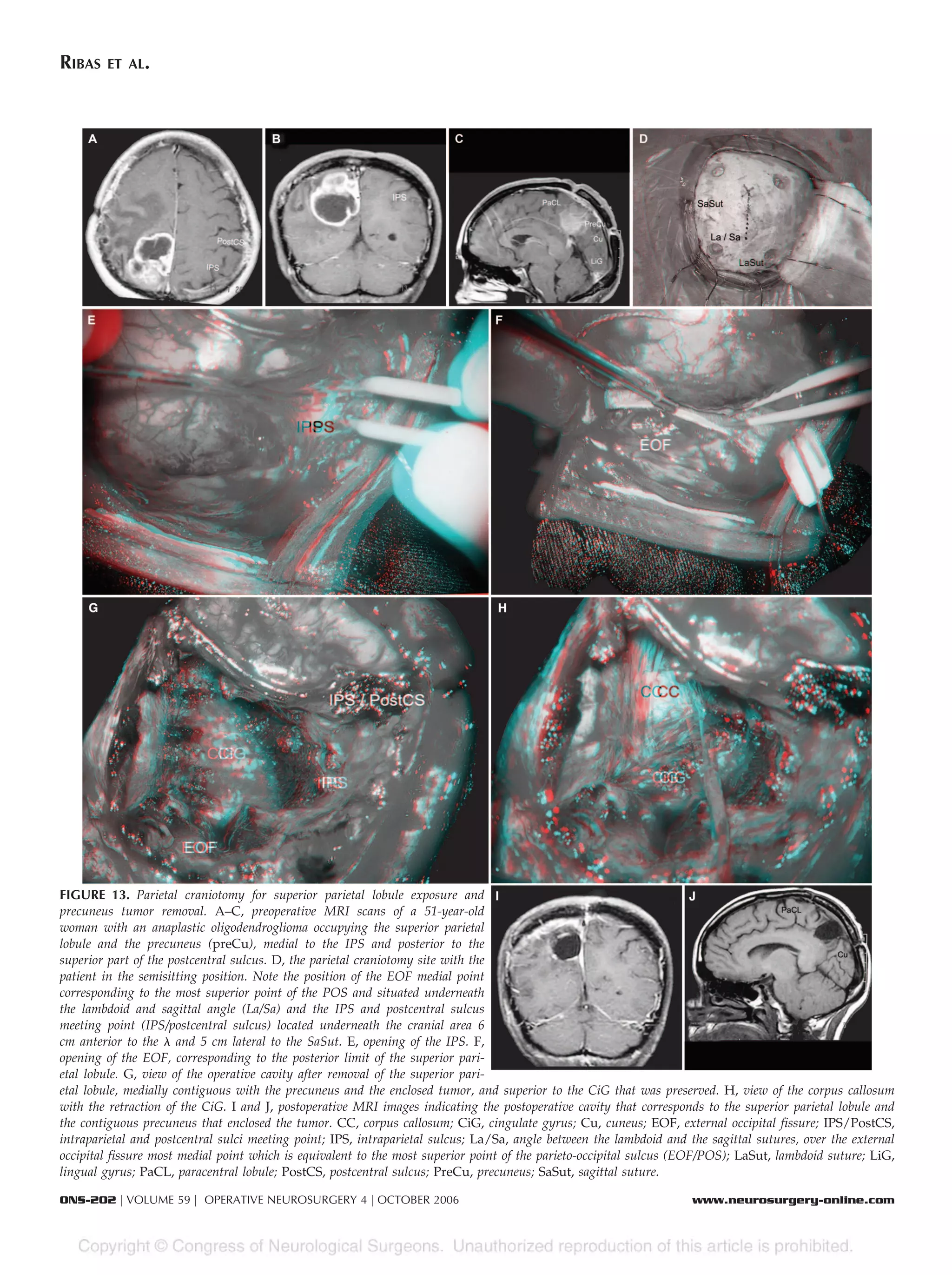 Surgical anatomy of microsurgical sulcal key points | PDF