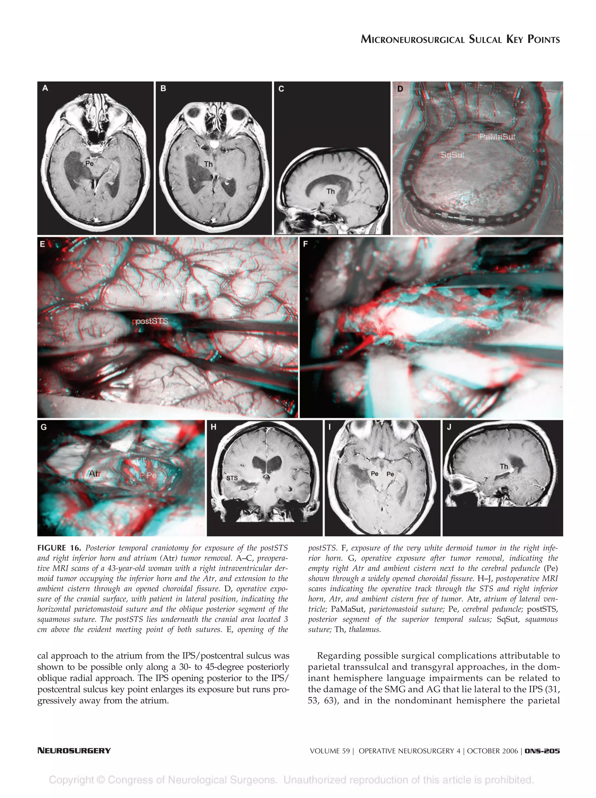 Surgical anatomy of microsurgical sulcal key points | PDF