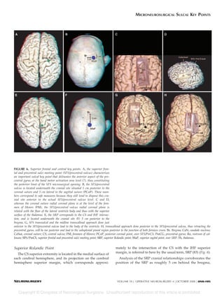 Surgical anatomy of microsurgical sulcal key points | PDF
