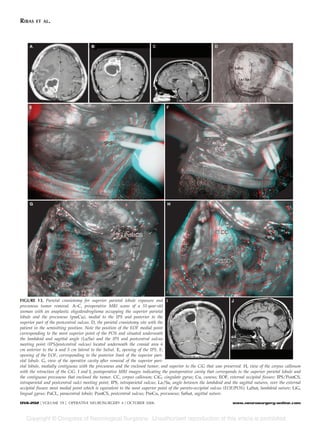 Surgical anatomy of microsurgical sulcal key points | PDF