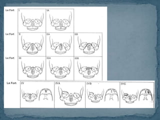 SURGICAL ANATOMY OF MID FACE.pptx