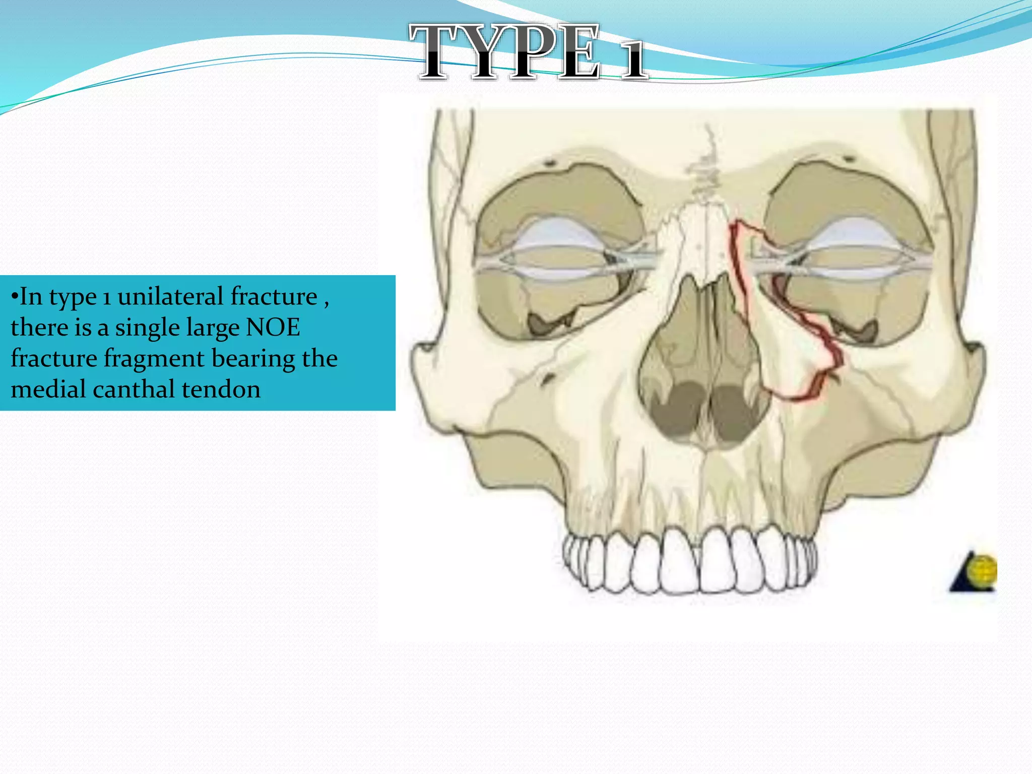 Surgical anatomy of Noe complex in context of trauma | PPTX