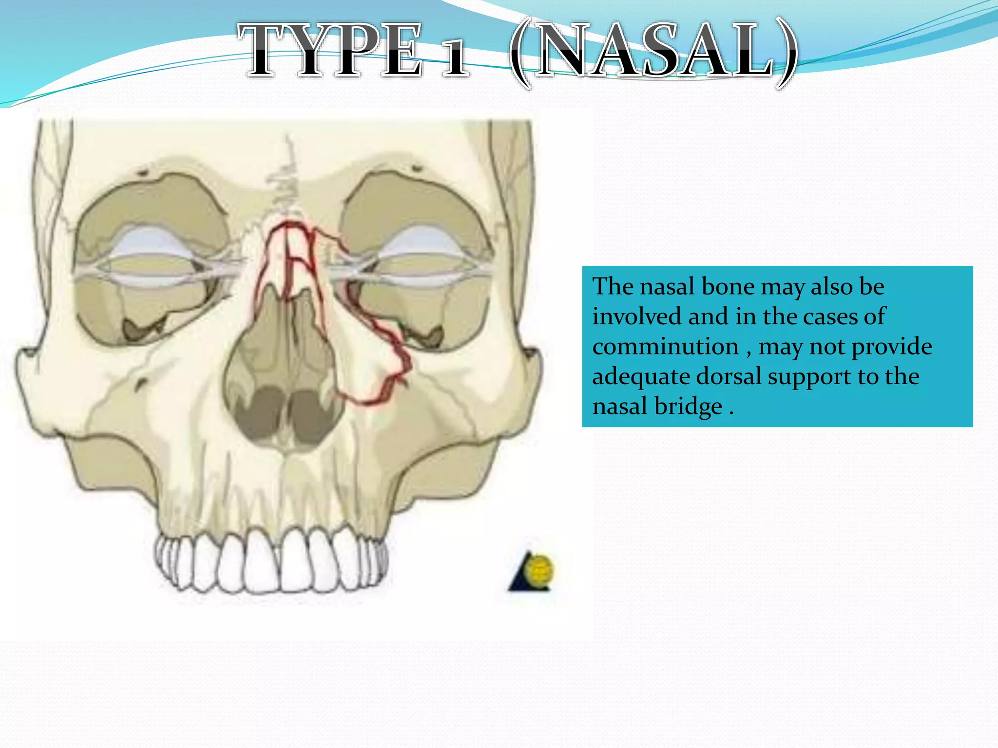 Surgical anatomy of Noe complex in context of trauma | PPTX