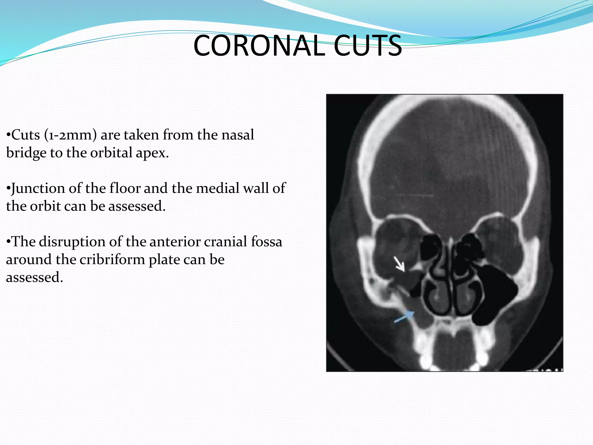 Surgical anatomy of Noe complex in context of trauma | PPTX