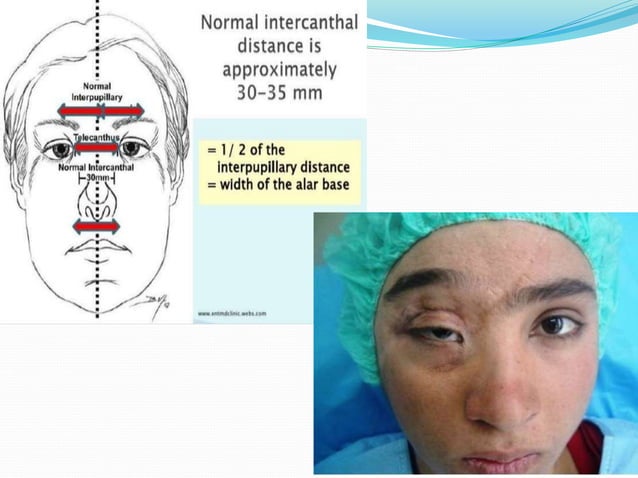 Surgical anatomy of Noe complex in context of trauma | PPT