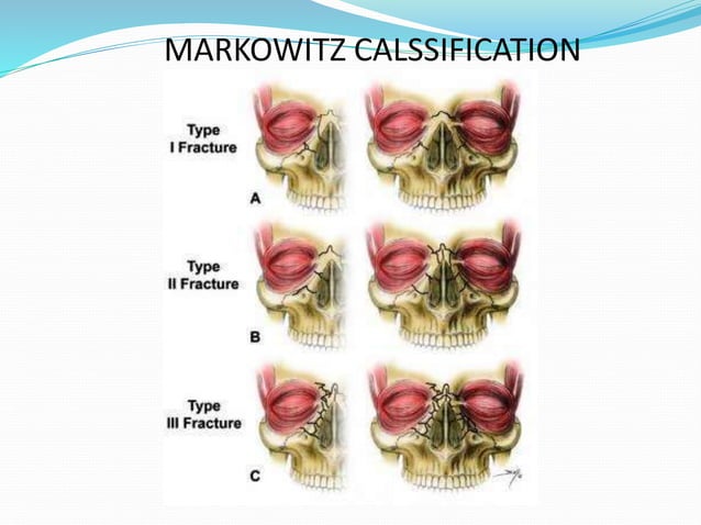 Surgical anatomy of Noe complex in context of trauma | PPT