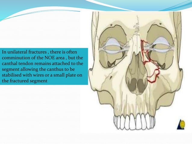 Surgical anatomy of Noe complex in context of trauma | PPT